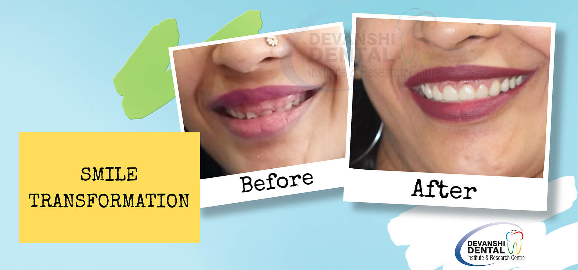 FMR Treatment in Pratap Nagar Sq | Full Mouth Rehabilitation